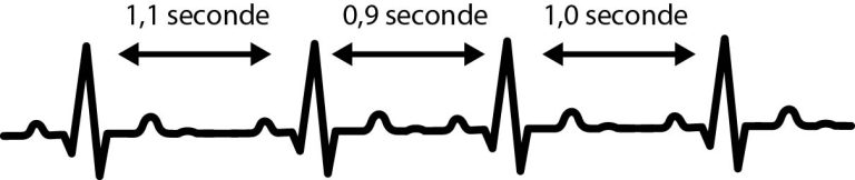 Wat is hartritmevariabiliteit? | Medicus Online